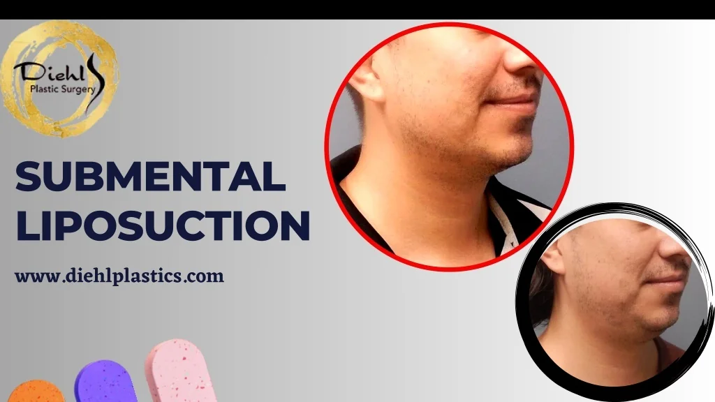PPT - Submental Liposuction: Sculpting a Sleeker Chin and Neck Profile ...