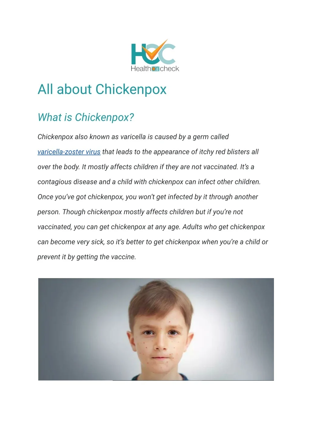 PPT - All about Chickenpox PowerPoint Presentation, free download - ID ...