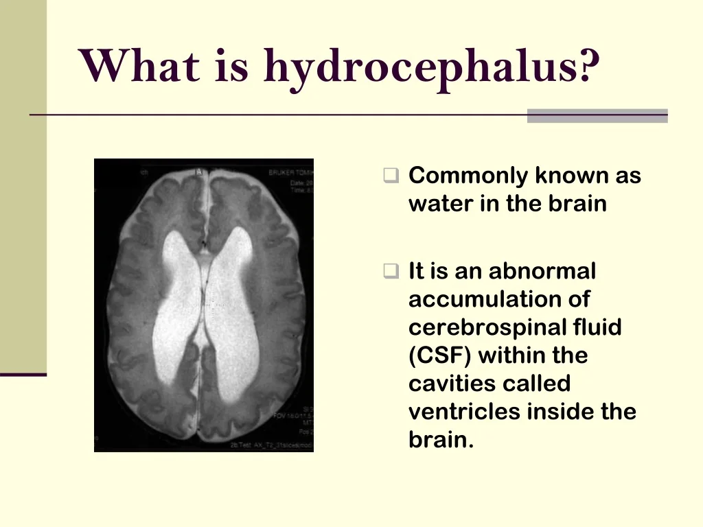 PPT - Hydrocephalus PowerPoint Presentation, free download - ID:12642322