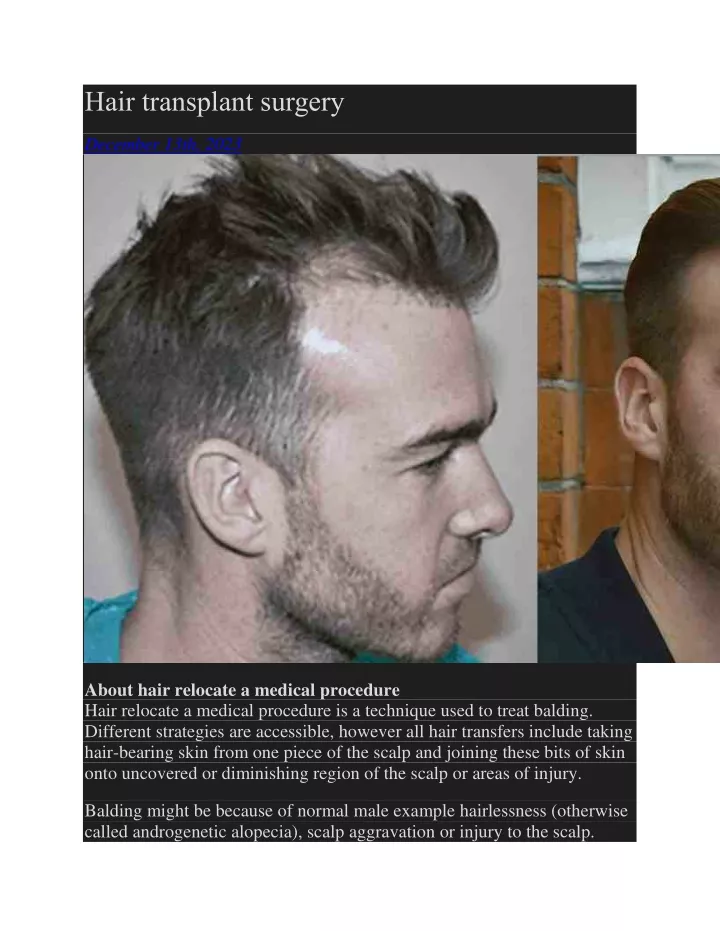 Ppt Hair Transplant Powerpoint Presentation Free Download Id