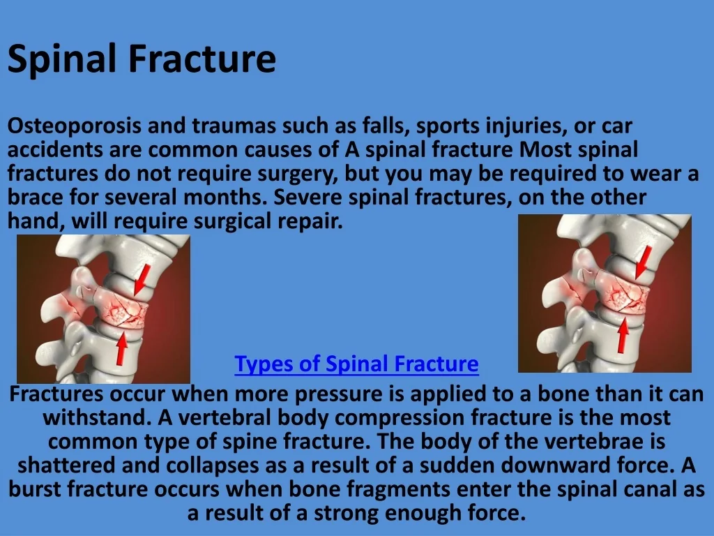 PPT - Spinal Fracture PowerPoint Presentation, free download - ID:12782297