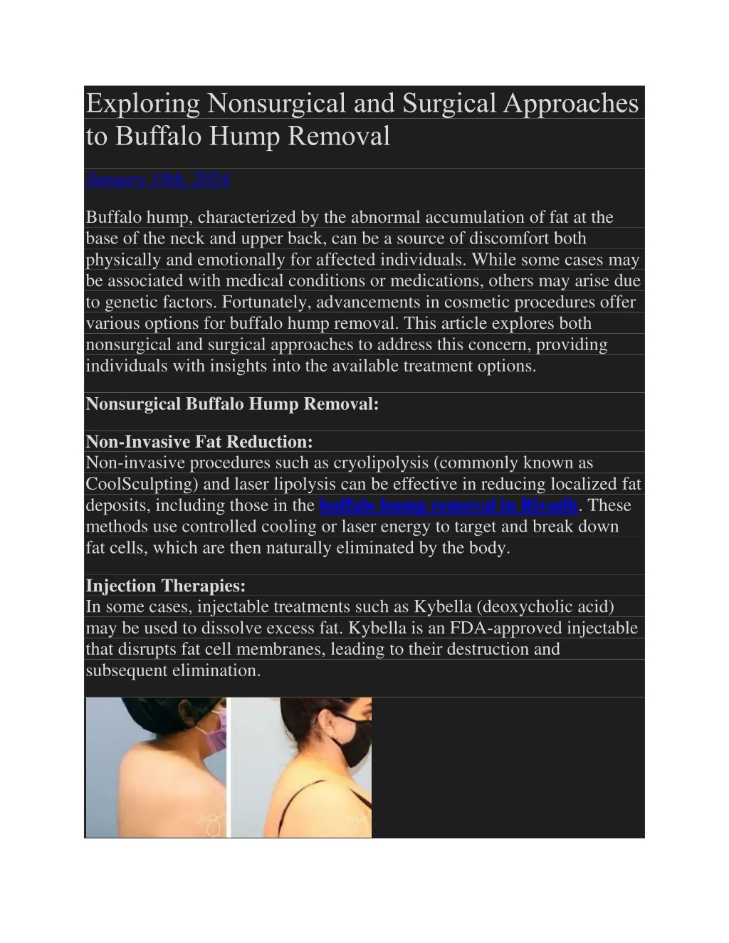 PPT - Exploring Nonsurgical and Surgical Approaches to Buffalo Hump ...