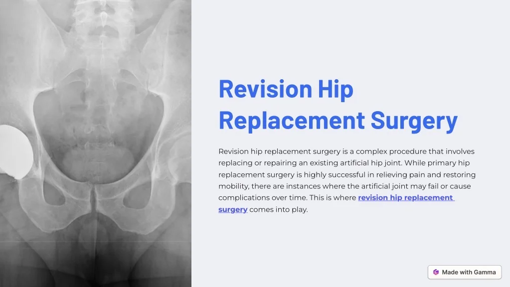 PPT - Revision Hip Replacement Surgery PowerPoint Presentation, free ...
