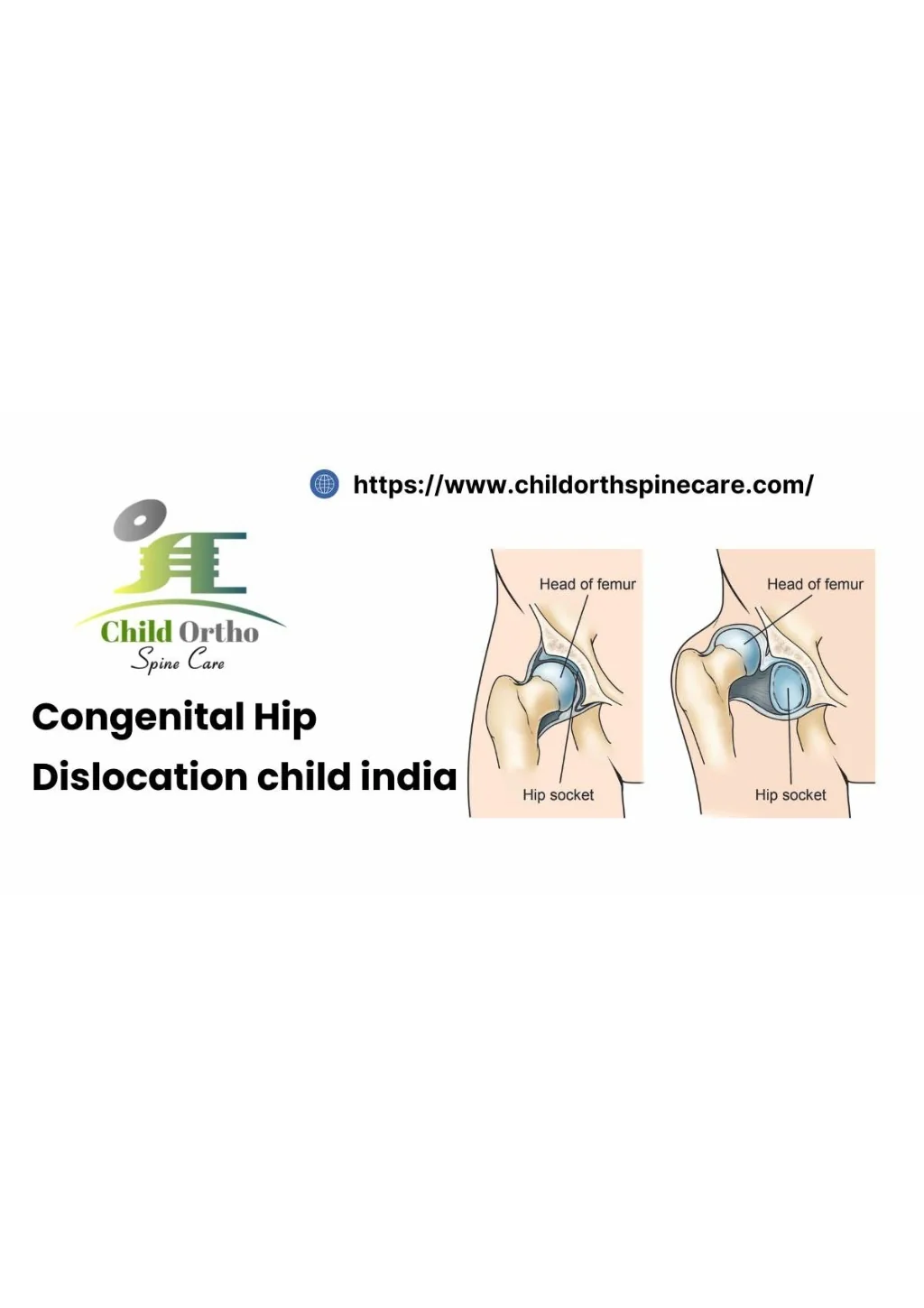 PPT - Congenital Hip dislocation child india PowerPoint Presentation ...